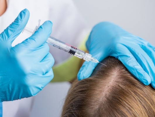 Injerto capilar Mallorca y tratamientos capilares en Clinica Capilar Nadal